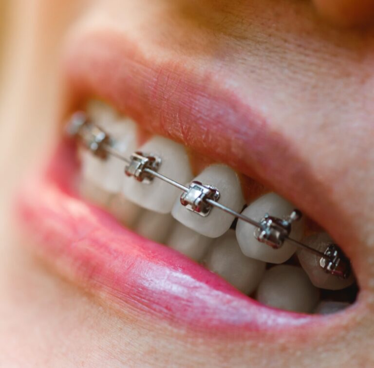 BioQuick Self-Ligating Braces | First Impression Orthodontics